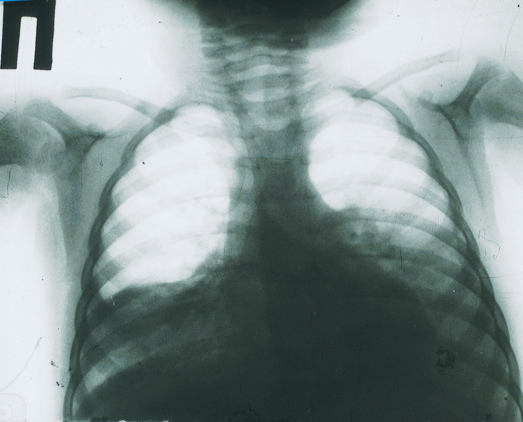 New Doctrine of Acute Pneumonia in Children - Unique Way to Prevent ...