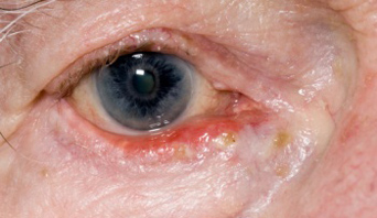 Medicine...Life: Case of bilateral congenital ectropion