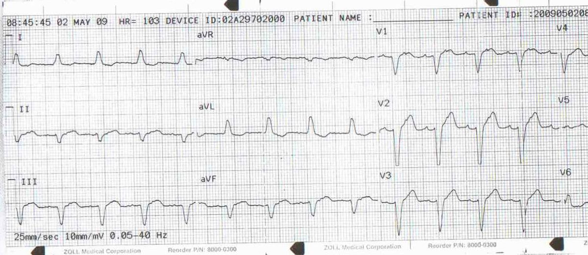 2:1 AVB & LBBB | Paramedicine 101