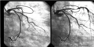 STEMI EKG & Angio | Paramedicine 101