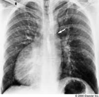 Dextrocardia | Paramedicine 101
