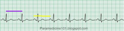 The Electrocardiogram - Part IV | Paramedicine 101
