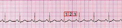 The Electrocardiogram - Part V | Paramedicine 101