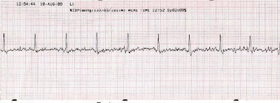 The Electrocardiogram - Part V | Paramedicine 101