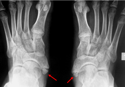 Os tibiale externum ( Accessory Navicular bone ) | The Third Eye ...