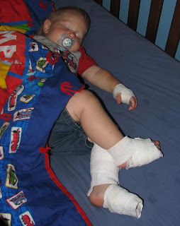 Tender Herb: Burns & Babies...