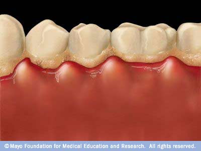 Dentistry: Gingivitis