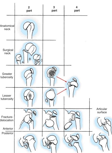 11:50: Clasificación de Neer