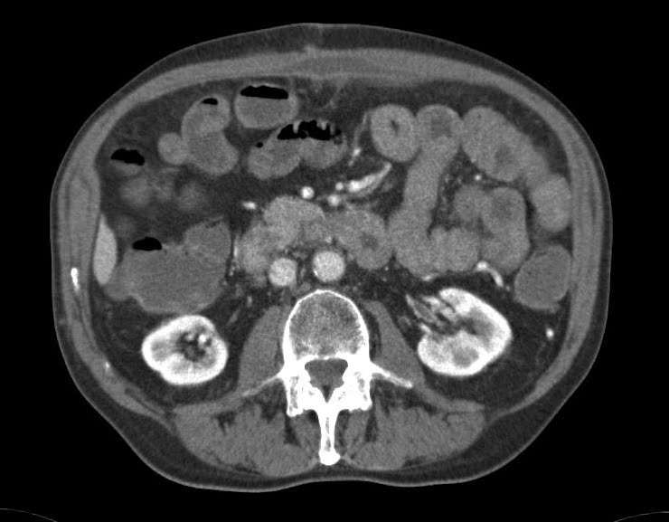 What have we learned today: Intestinal amyloidosis