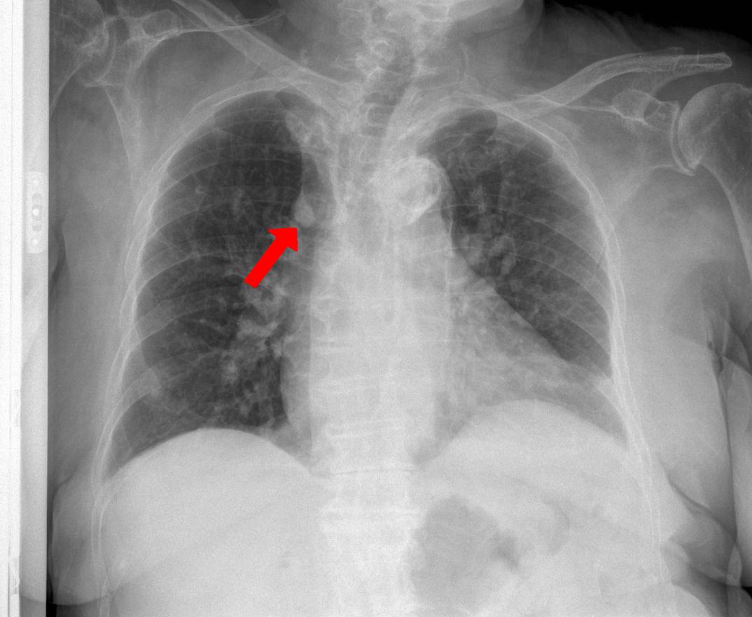 What have we learned today: Azygos fissure
