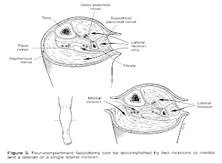 surgical operations: Fasciotomy