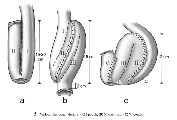 surgical operations: Ileoanal pouch
