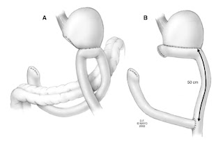 surgical operations: Distal Gastrectomy