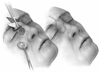 surgical operations: Facial skin cancers