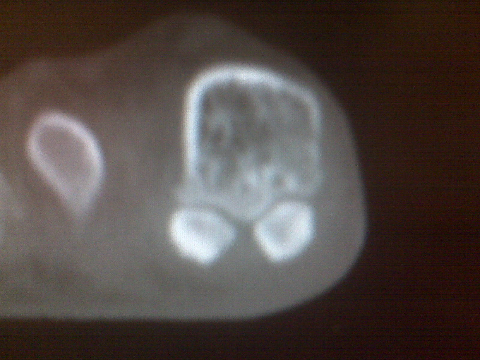 Foot and Ankle Problems By Dr. Richard Blake: Sesamoid Fractures ...