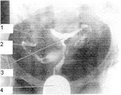 AKHSANUR BLOG'S: Teknik Radiografi Histerosalpingografi (HSG)