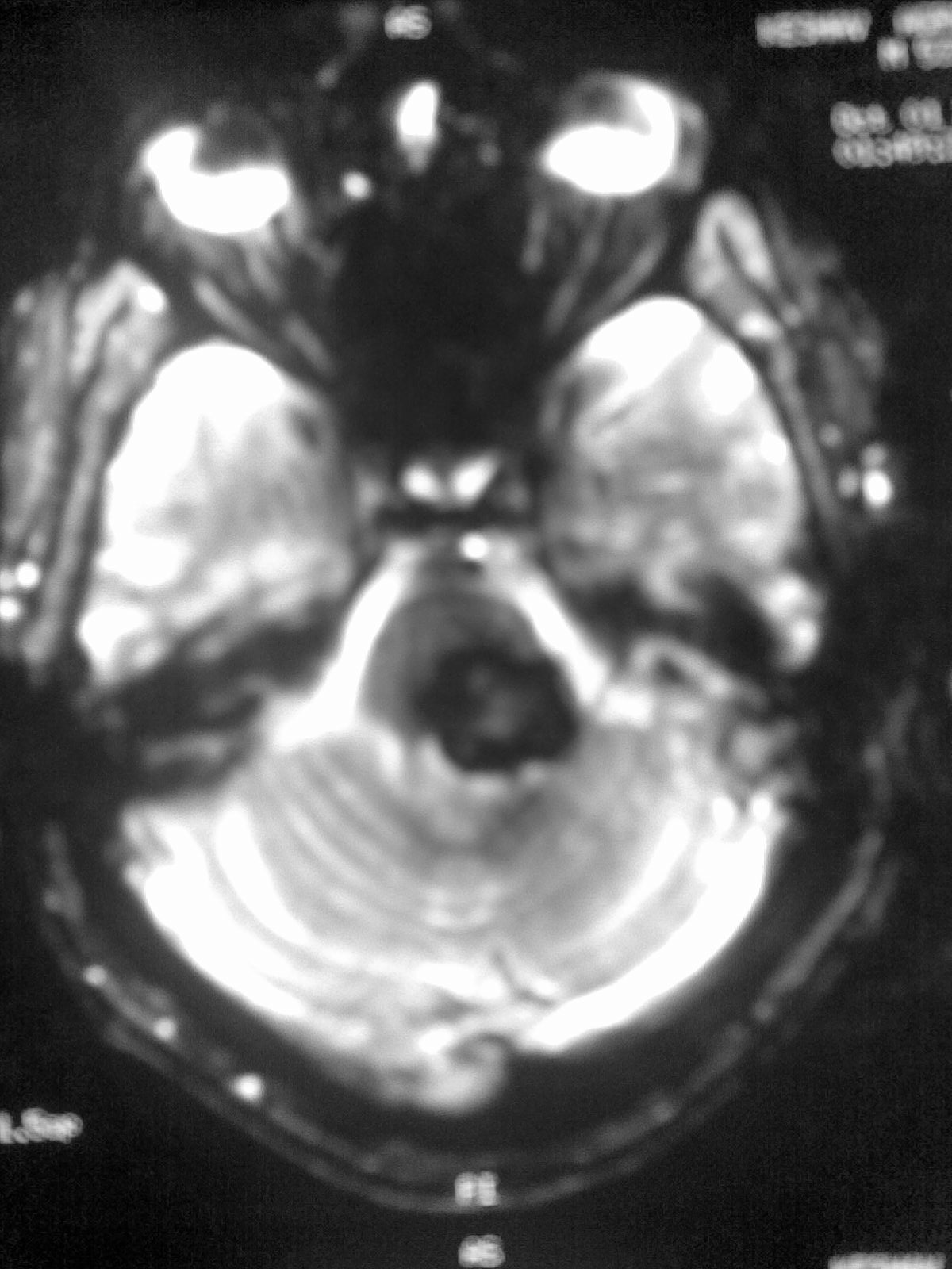Hypertrophic Inferior Olivary degeneration due to brainstem cavernoma ...