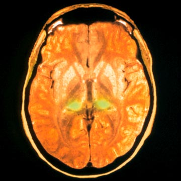 Digital Scrapbook: Brain Disease 'Resistance Gene' Evolves in Papua New ...