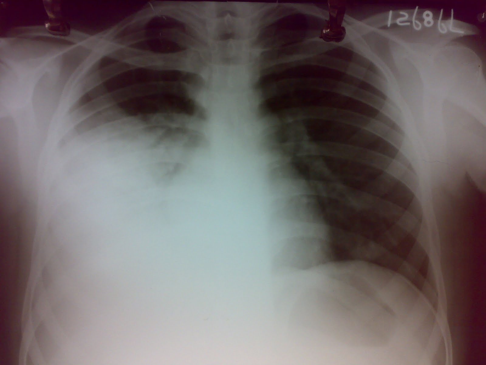 Dr. Amir's Blog: Chest X ray