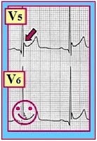ECG Interpretation: ECG Interpretation Review - #2 ("Smiley" ST, ST ...