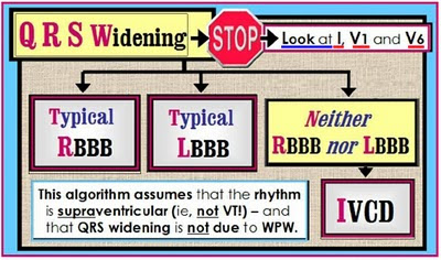 ECG Interpretation: ECG Interpretation Review #13 (BBB, Wide QRS, Is ...