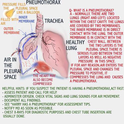 Dear Nurses: TRAUMA SERIES " PNEUMOTHORAX