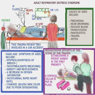 Dear Nurses: ARDS IN THE ICU TRAUMA PATIENT