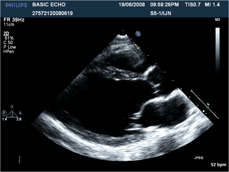 CVT Mohd Farid: Basic Echo Window :Parasternal Long Axis View