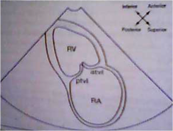 Cvt Mohd Farid Basic Echo Window Parasternal Long Axis View Rv Inflow