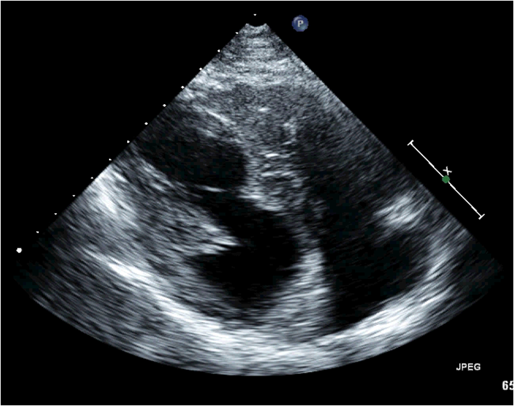 CVT Mohd Farid: Basic Echo Window :Parasternal Long Axis View :RV Inflow