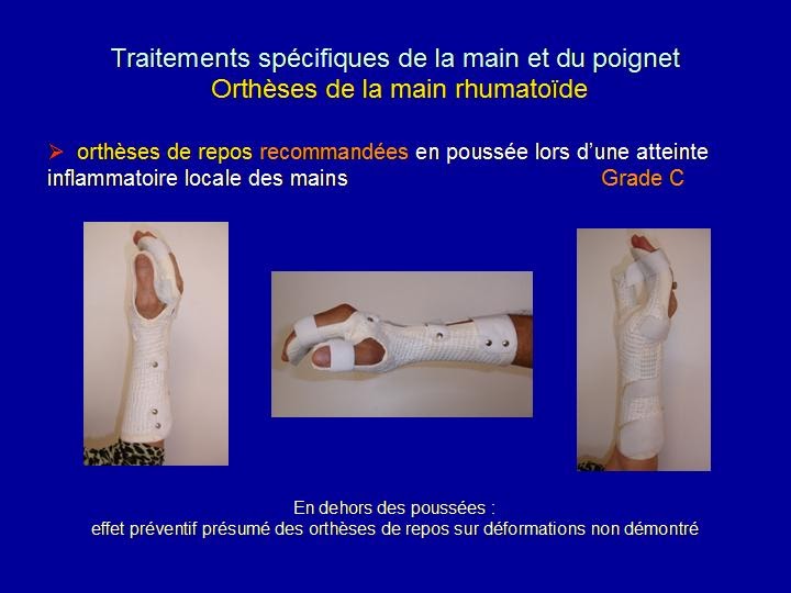 Orthèses sur mesure et appareillage personnalisé main poignet doigts ...