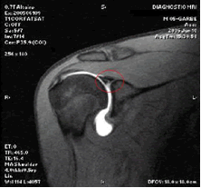 DoJoNa: Slap Lesion & Surgery