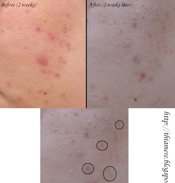 ~on beauty stuff and what else's....~: product rerun: Kojie-san Kojic ...