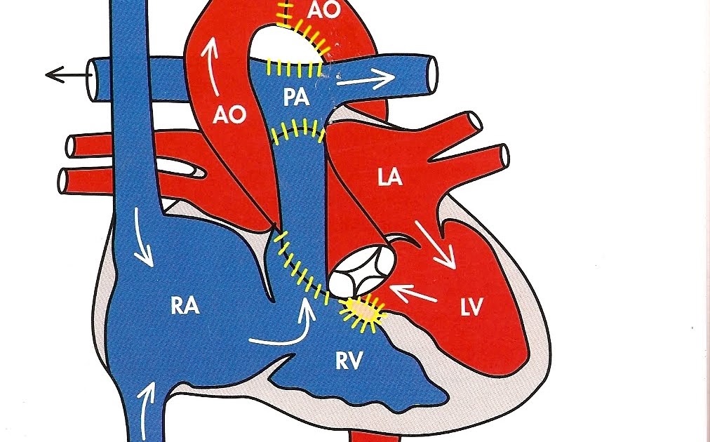 Heart defects, for everyone: The Rastelli Procedure