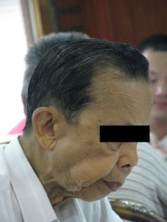 Medical and Health Blog from a Medical Student: Franks Sign - Diagonal ...