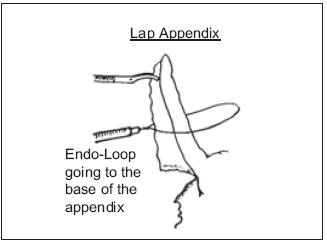 Endoscopia Ginecologica: Apendicectomia laparoscopica