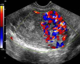 Endoscopia Ginecologica: Embarazo cervical