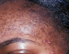 African American Skin Acne Treatment in NYC: 2009