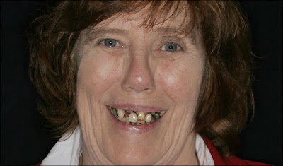 Woman With Tooth Decay | Rotten Teeth Pictures