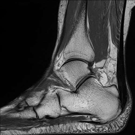 Radiology Cases: Haglund's Deformity and Syndrome