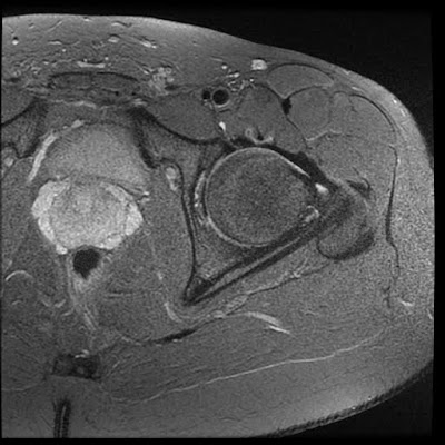 Radiology Cases: Snapping Hip Syndrome