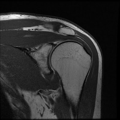 Radiology Cases: Adhesive Capsulitis