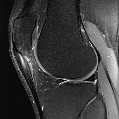 Radiology Cases: Proximal Patella Tendinosis and Interstitial Tear