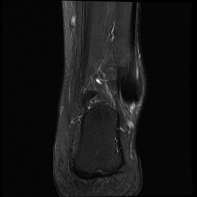 Radiology Cases: Peroneus Brevis Split Tear and Lateral Subluxation of ...