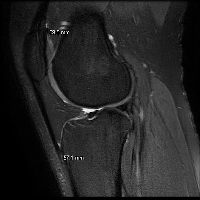 Radiology Cases: Lateral Patella Subluxation, Patella Tilt, Shallow ...