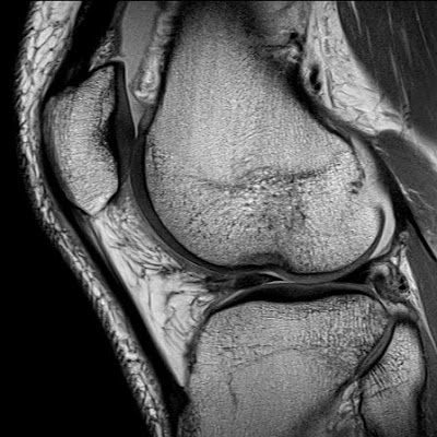 Radiology Cases: Deep Lateral Sulcus Sign (Deep Femoral Notch Sign) and ...