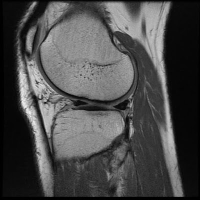 Radiology Cases: Anterior Tibial Translation Sign in ACL Tear