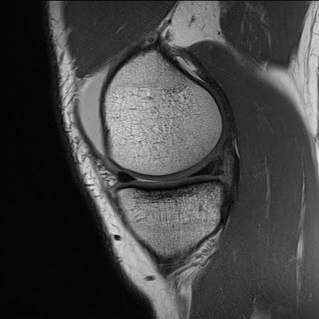 Radiology Cases: Vertical Tear MM