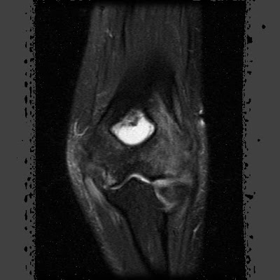 Radiology Cases: MCL and CFO tear with partial tear CEO