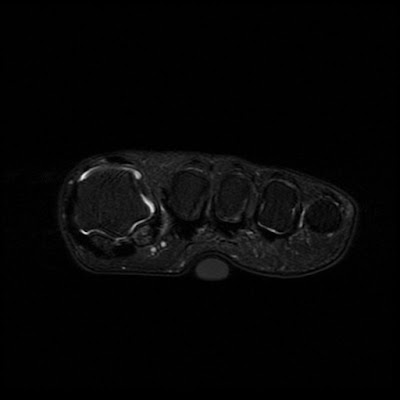 Radiology Cases: Lateral Sesamoiditis and 1st MTP synovitis